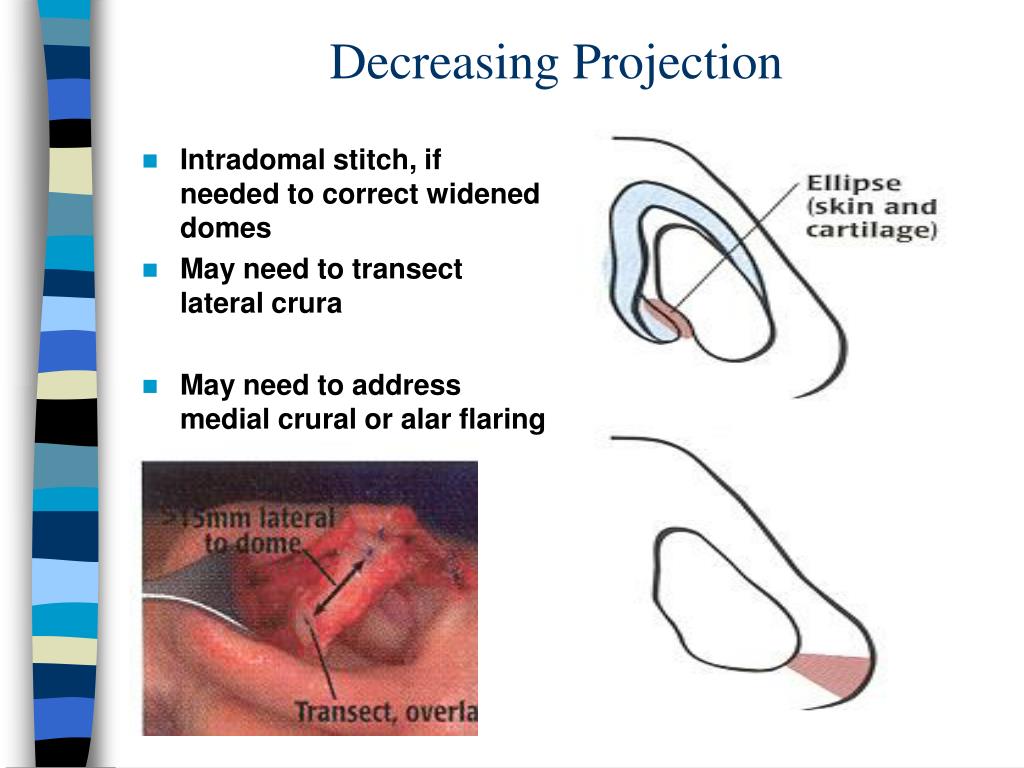 Ppt Anatomical Approach To Rhinoplasty Powerpoint Presentation Free