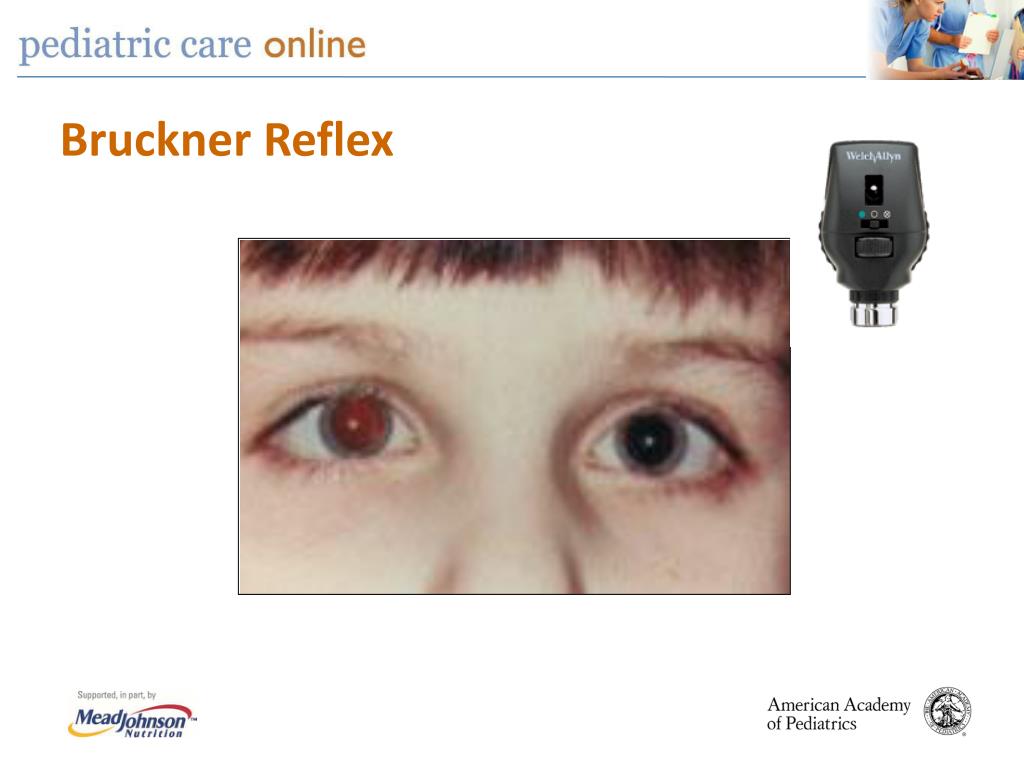 PPT - Pediatric Vision Screening David Granet, MD, FAAP Chair, AAP ...