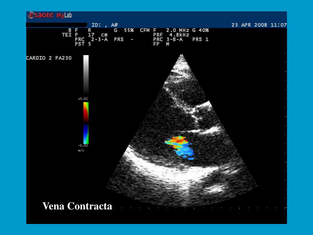 PPT - Valutazione quantitativa dell’insufficienza mitralica Frank L ...