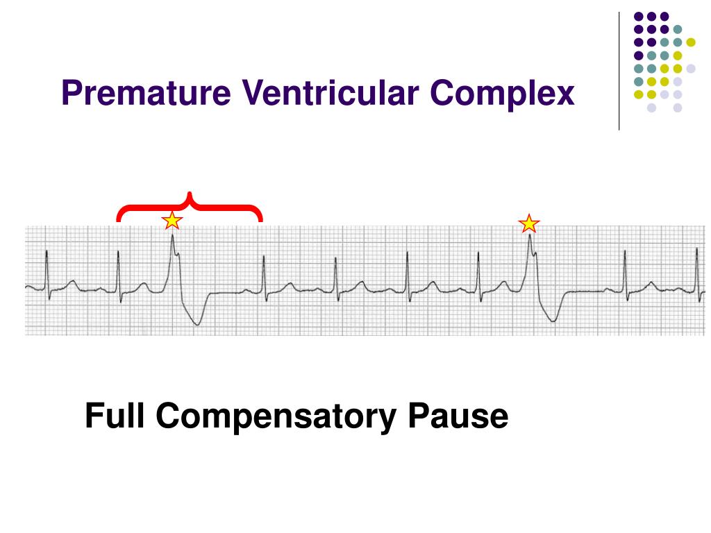 PPT - Ventriküler aritmiler PowerPoint Presentation, free download - ID ...