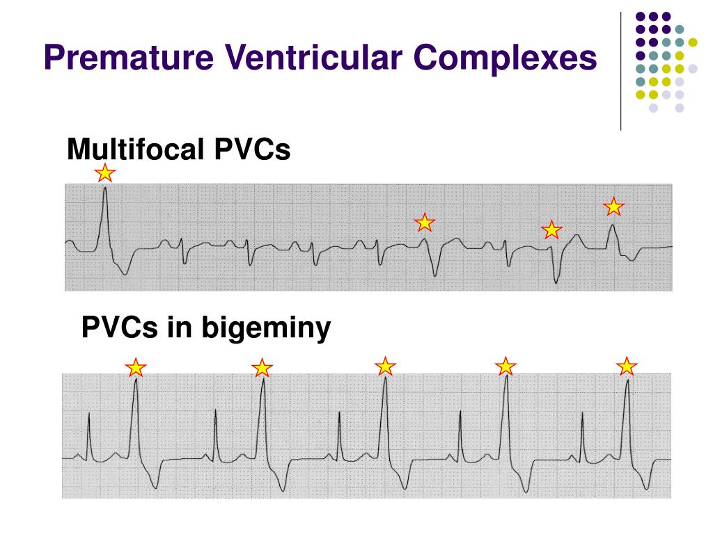 PPT - Ventriküler aritmiler PowerPoint Presentation, free download - ID ...