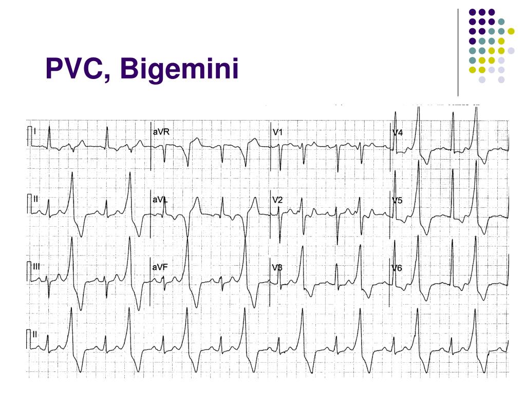 PPT - Ventriküler aritmiler PowerPoint Presentation, free download - ID ...