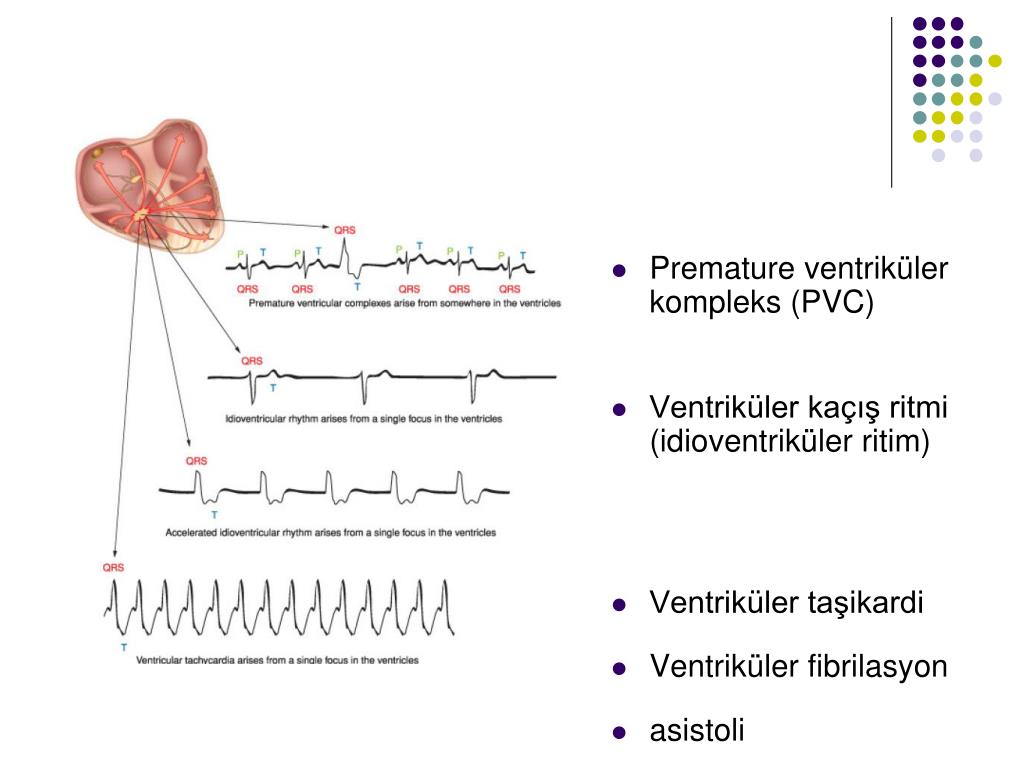 PPT - Ventriküler aritmiler PowerPoint Presentation, free download - ID ...