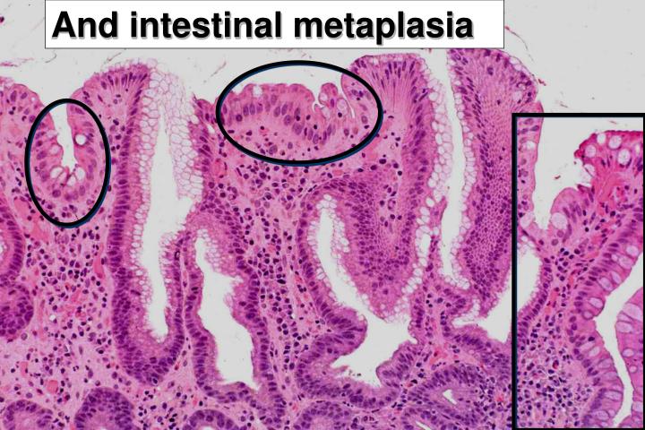 PPT - Atrophic gastritides PowerPoint Presentation - ID:3391079