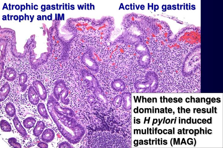PPT - Atrophic gastritides PowerPoint Presentation - ID:3391079