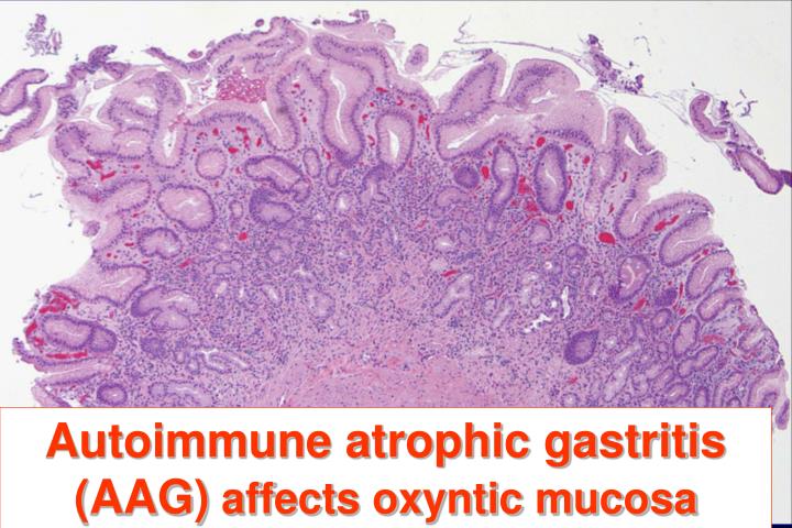PPT - Atrophic gastritides PowerPoint Presentation - ID:3391079