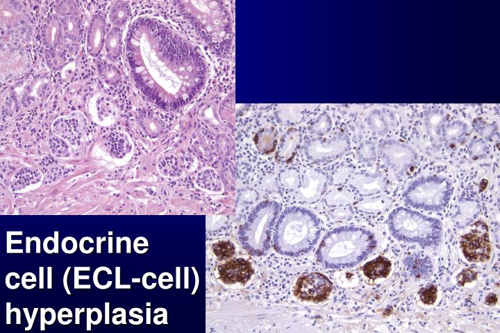 PPT - Atrophic gastritides PowerPoint Presentation - ID:3391079