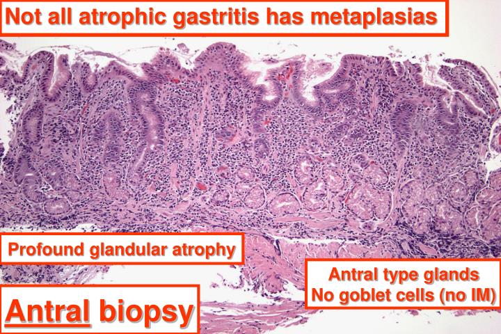 PPT - Atrophic gastritides PowerPoint Presentation - ID:3391079