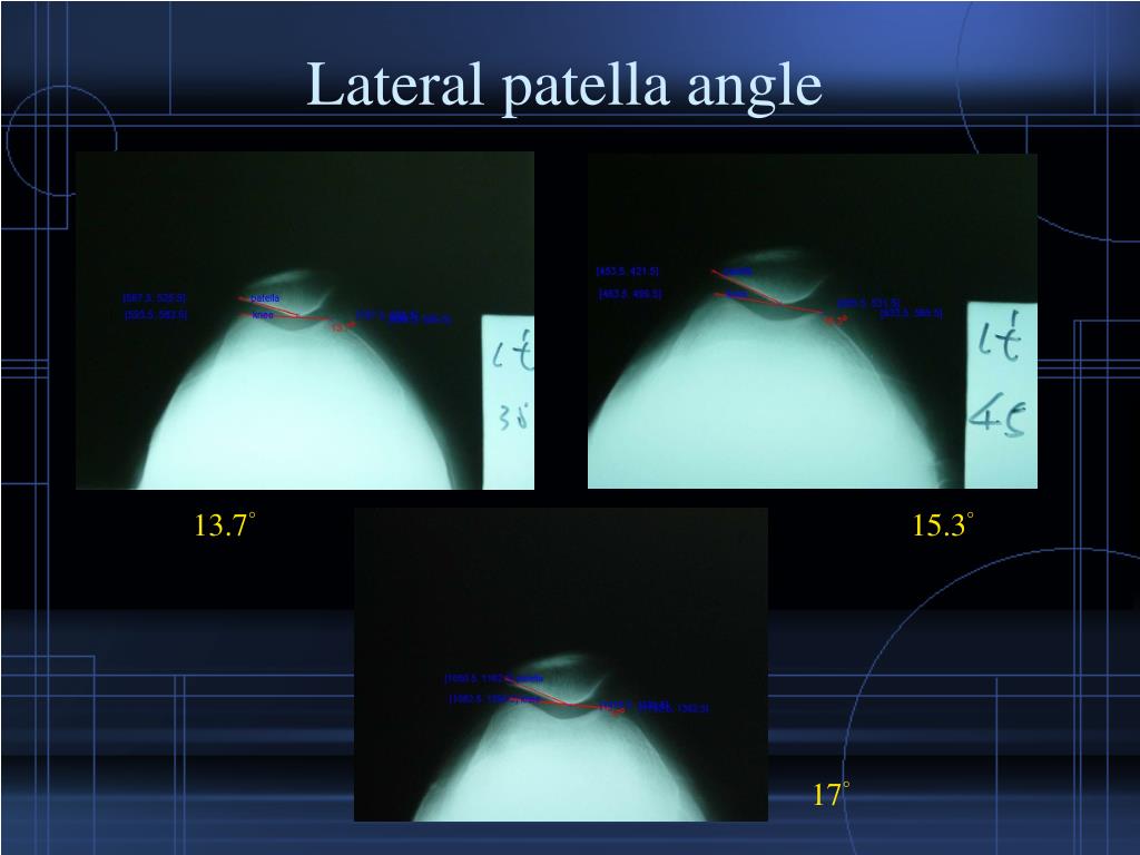 PPT - The Influence of Vastus Muscle and Patella Alignment in Subjects ...