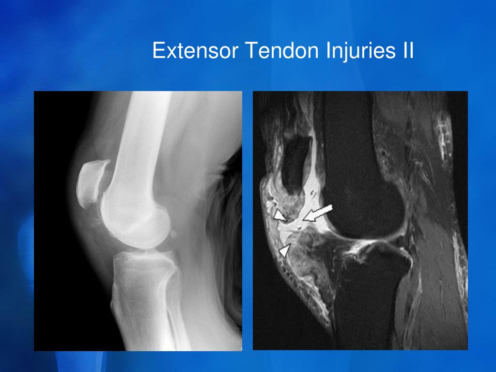 PPT - Clinical Anatomy of the knee PowerPoint Presentation, free ...