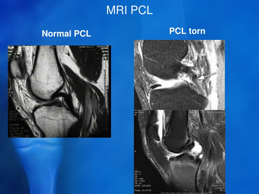 PPT - Clinical Anatomy of the knee PowerPoint Presentation, free ...