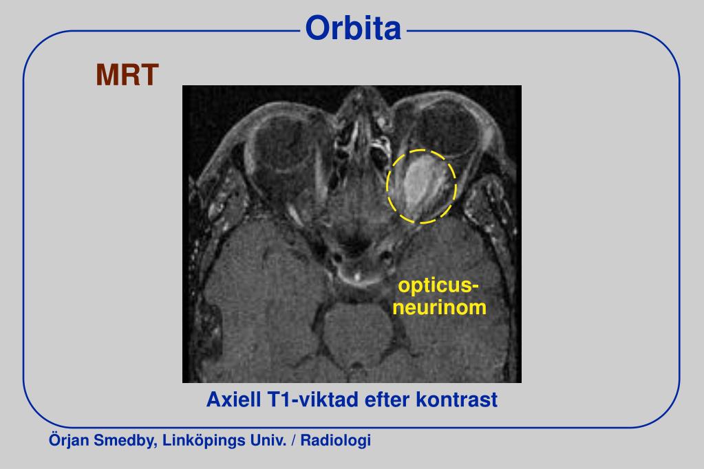 PPT - Huvud-hals-radiologi PowerPoint Presentation, free download - ID ...