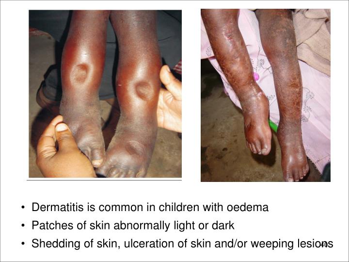 PPT - Integrated Management of Acute Malnutrition PowerPoint ...