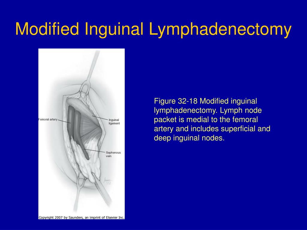 Ppt Surgery Of Penile And Urethral Carcinoma Powerpoint Presentation Id3396308
