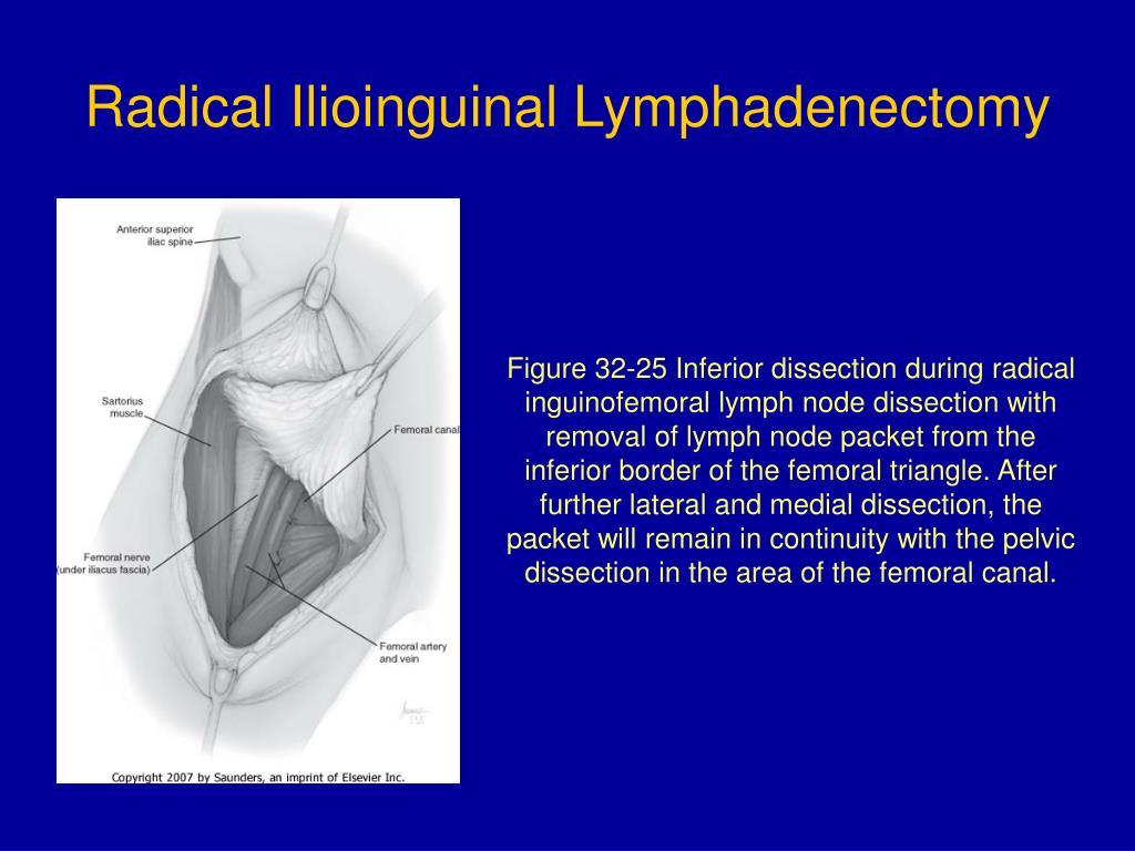 PPT - Surgery of Penile and Urethral Carcinoma PowerPoint Presentation ...
