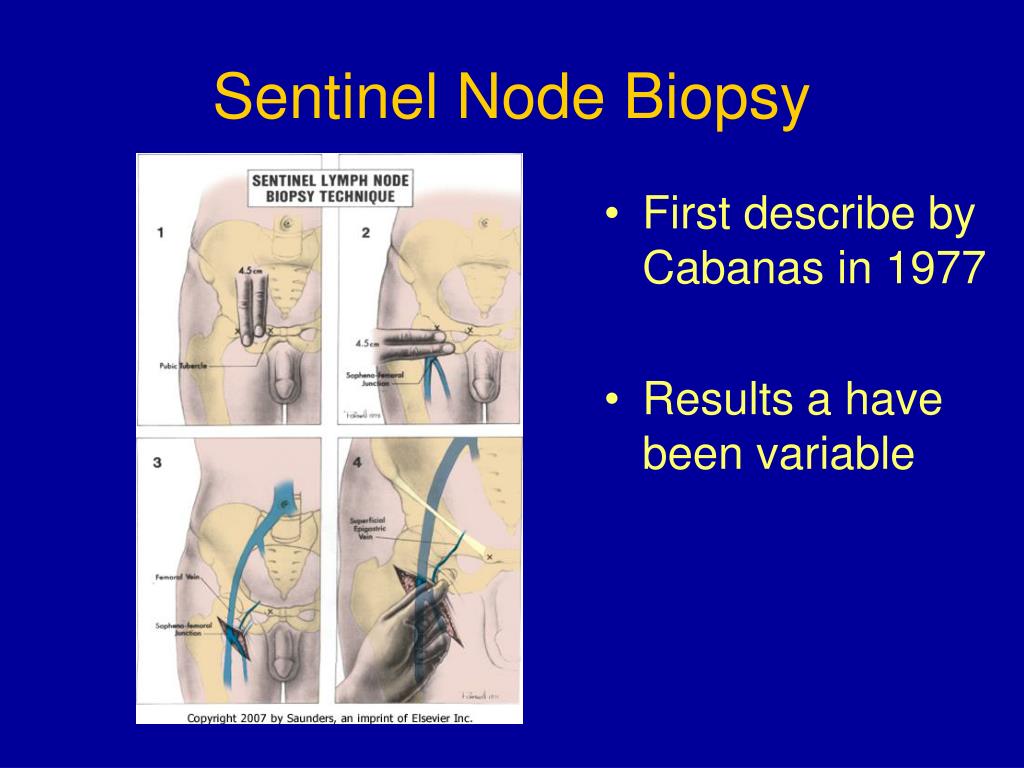 PPT - Surgery of Penile and Urethral Carcinoma PowerPoint Presentation ...