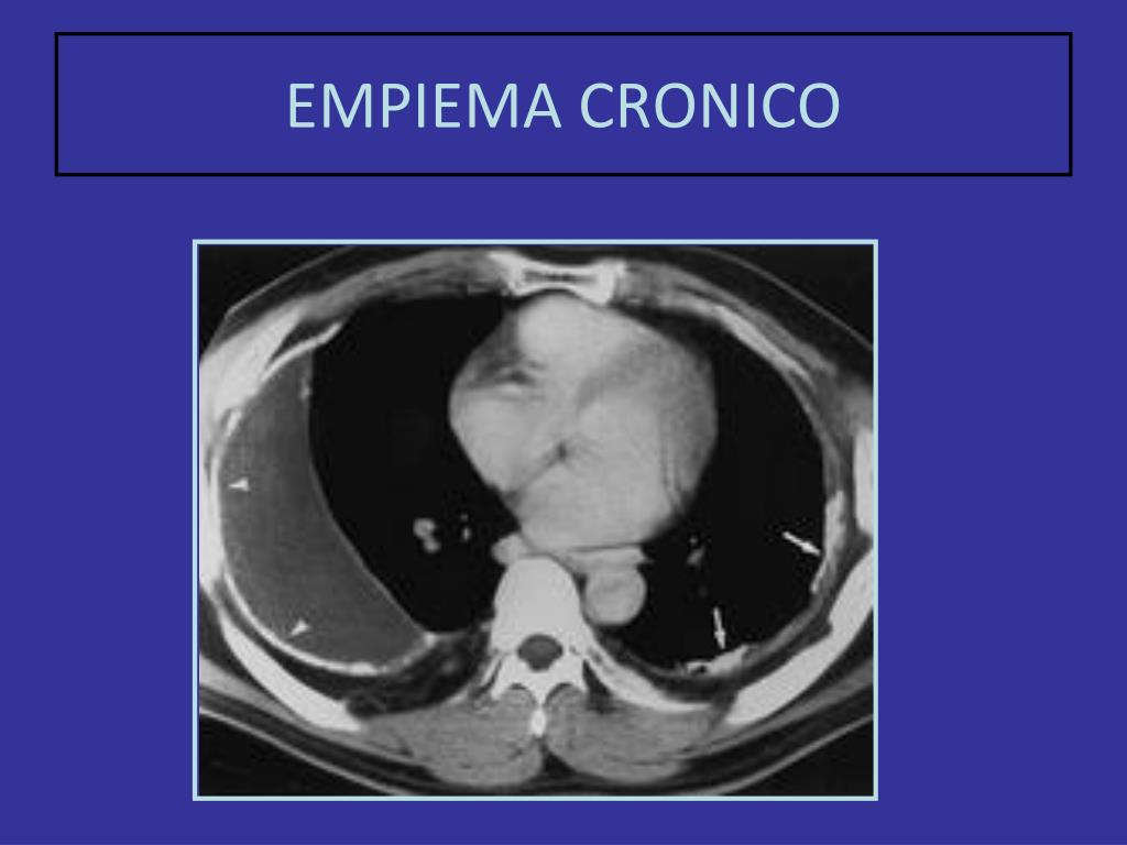 PPT - Tuberculosis: situación actual en el mundo y en la Argentina ...