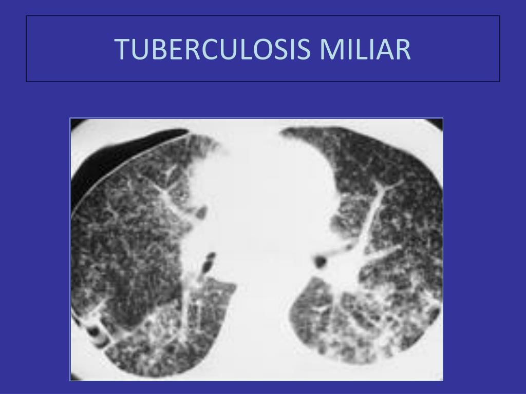 PPT - Tuberculosis: situación actual en el mundo y en la Argentina ...