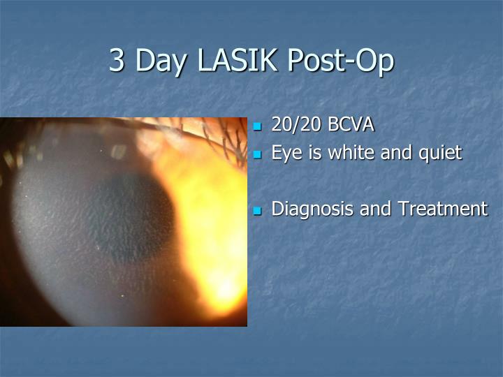 PPT - Diffuse Lamellar Keratitis PowerPoint Presentation - ID:3398386