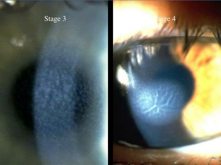 PPT - Diffuse Lamellar Keratitis PowerPoint Presentation - ID:3398386