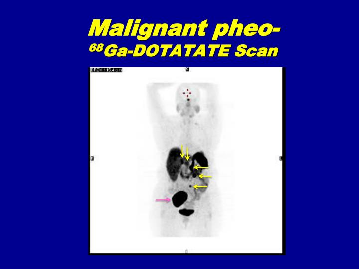 PPT - Endocrine Hypertension PowerPoint Presentation - ID:3399474