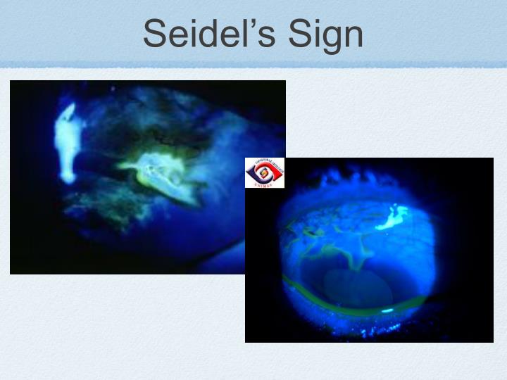 PPT - postoperative cataract complications PowerPoint Presentation - ID ...