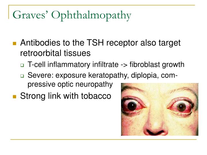 PPT - Graves’ Disease: An Overview PowerPoint Presentation - ID:3401926