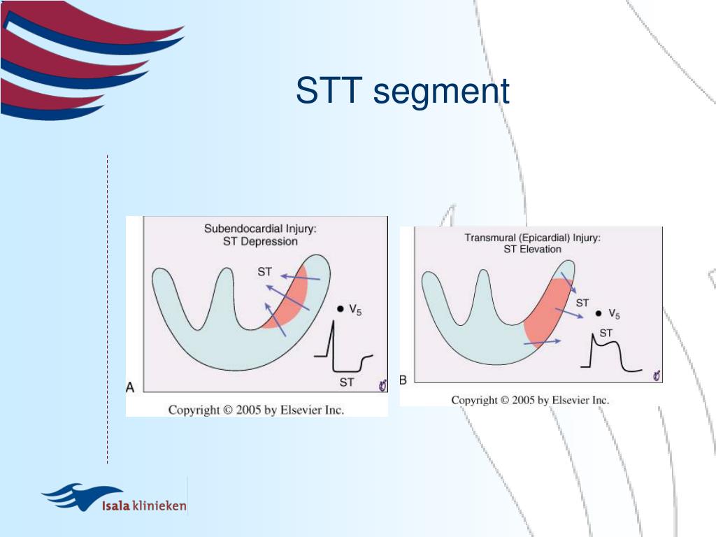 PPT - ECG-onderwijs: Ritme- en geleidingsstoornissen PowerPoint ...