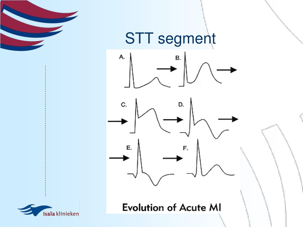 PPT - ECG-onderwijs: Ritme- en geleidingsstoornissen PowerPoint ...