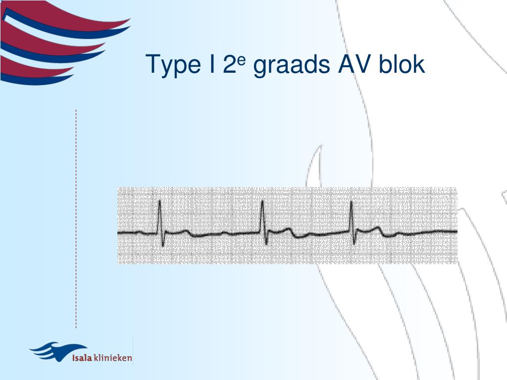 PPT - ECG-onderwijs: Ritme- en geleidingsstoornissen PowerPoint ...