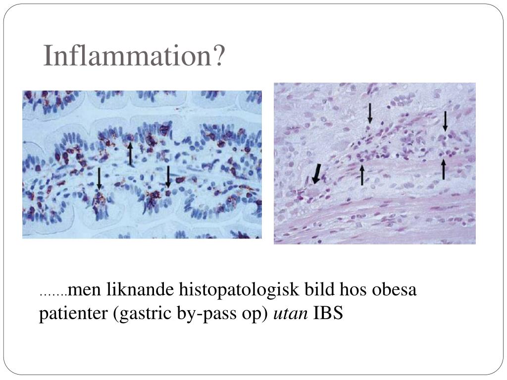 PPT - IBS - diagnostik , behandling och differentialdiagnoser Fredrik ...