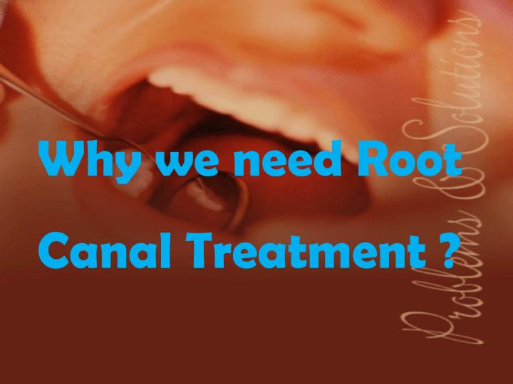 PPT - Why we need Root Canal Treatment ? PowerPoint Presentation, free ...