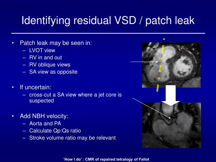 PPT - ‘How I do’: CMR of repaired tetralogy of Fallot PowerPoint ...