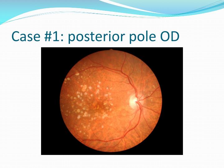 PPT - Etiology And Evaluation Of ARMD PowerPoint Presentation - ID:3409866