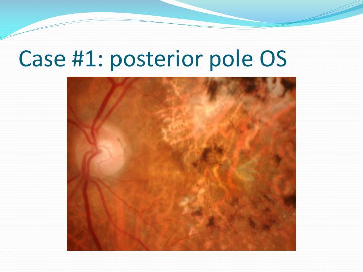 PPT - Etiology And Evaluation Of ARMD PowerPoint Presentation - ID:3409866