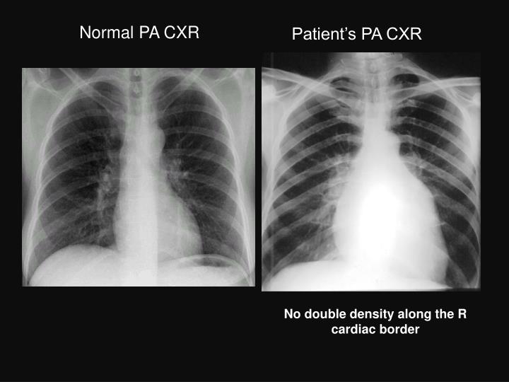PPT - Chest PA Chest Lat PowerPoint Presentation - ID:3410830