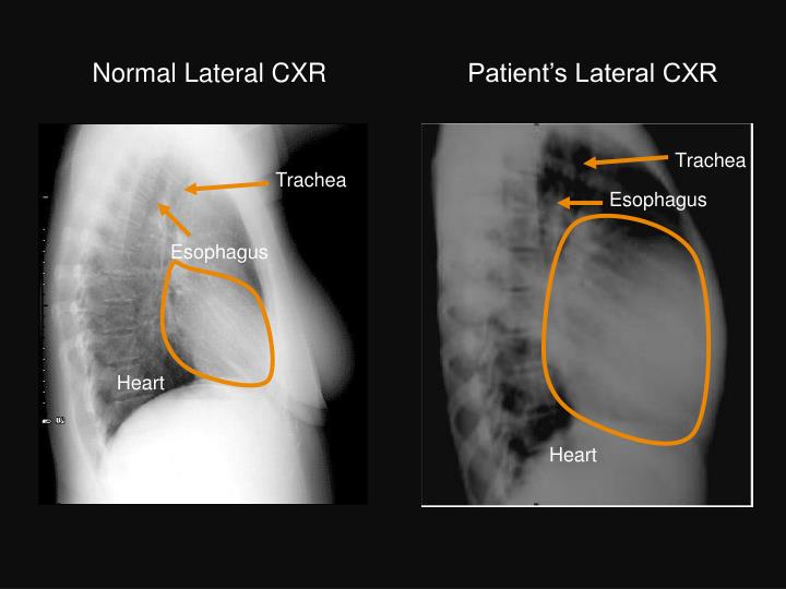 PPT - Chest PA Chest Lat PowerPoint Presentation - ID:3410830