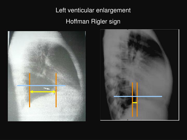 PPT - Chest PA Chest Lat PowerPoint Presentation - ID:3410830