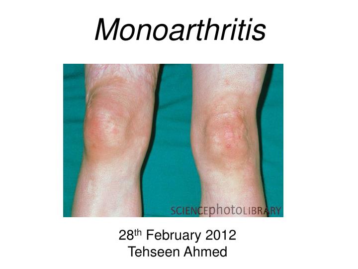 PPT - Monoarthritis PowerPoint Presentation, free download - ID:3412078