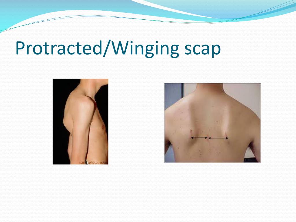 PPT - Assessment of Shoulder Pain PowerPoint Presentation, free ...