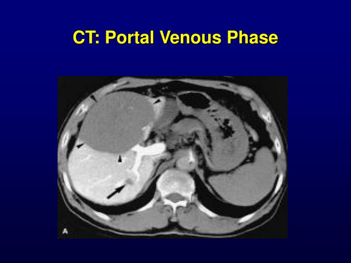 PPT - Hepatocellular Carcinoma Detection and Treatment PowerPoint ...