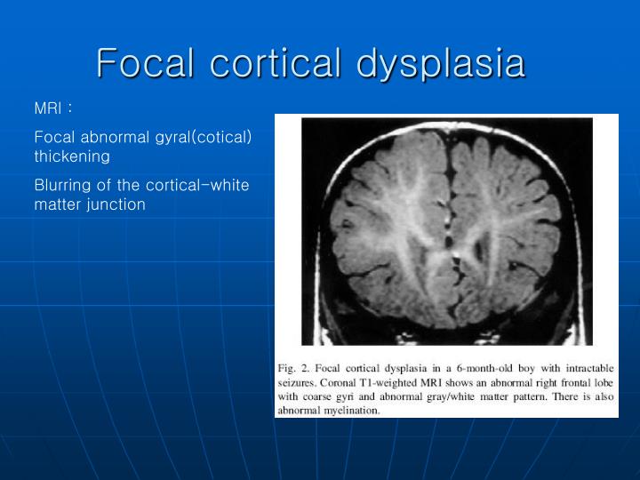 PPT - Cortical dysplasia PowerPoint Presentation - ID:3412768