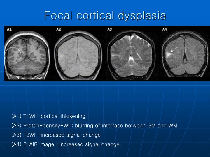 PPT - Cortical dysplasia PowerPoint Presentation - ID:3412768