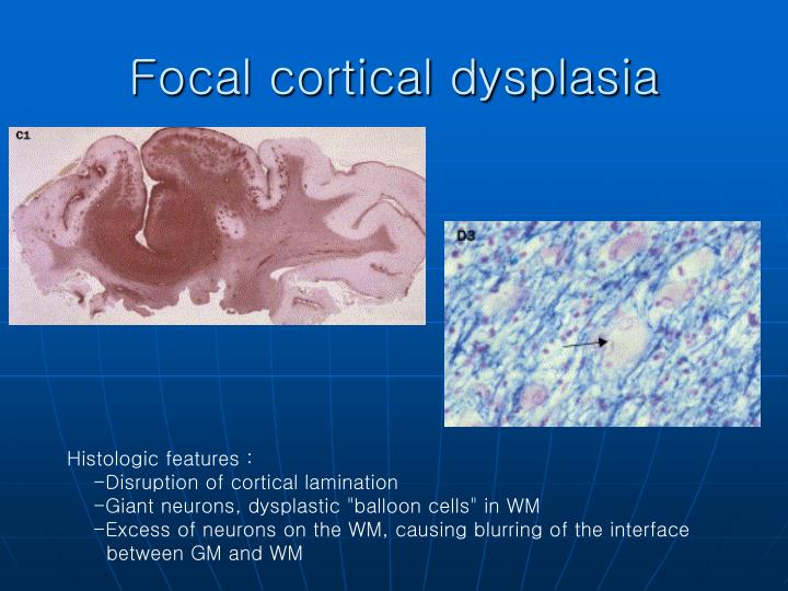 PPT - Cortical dysplasia PowerPoint Presentation - ID:3412768