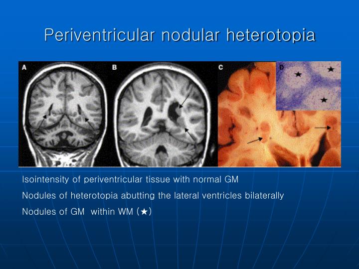 PPT - Cortical dysplasia PowerPoint Presentation - ID:3412768