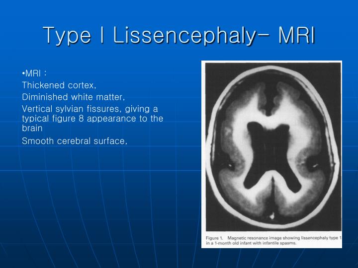PPT - Cortical dysplasia PowerPoint Presentation - ID:3412768