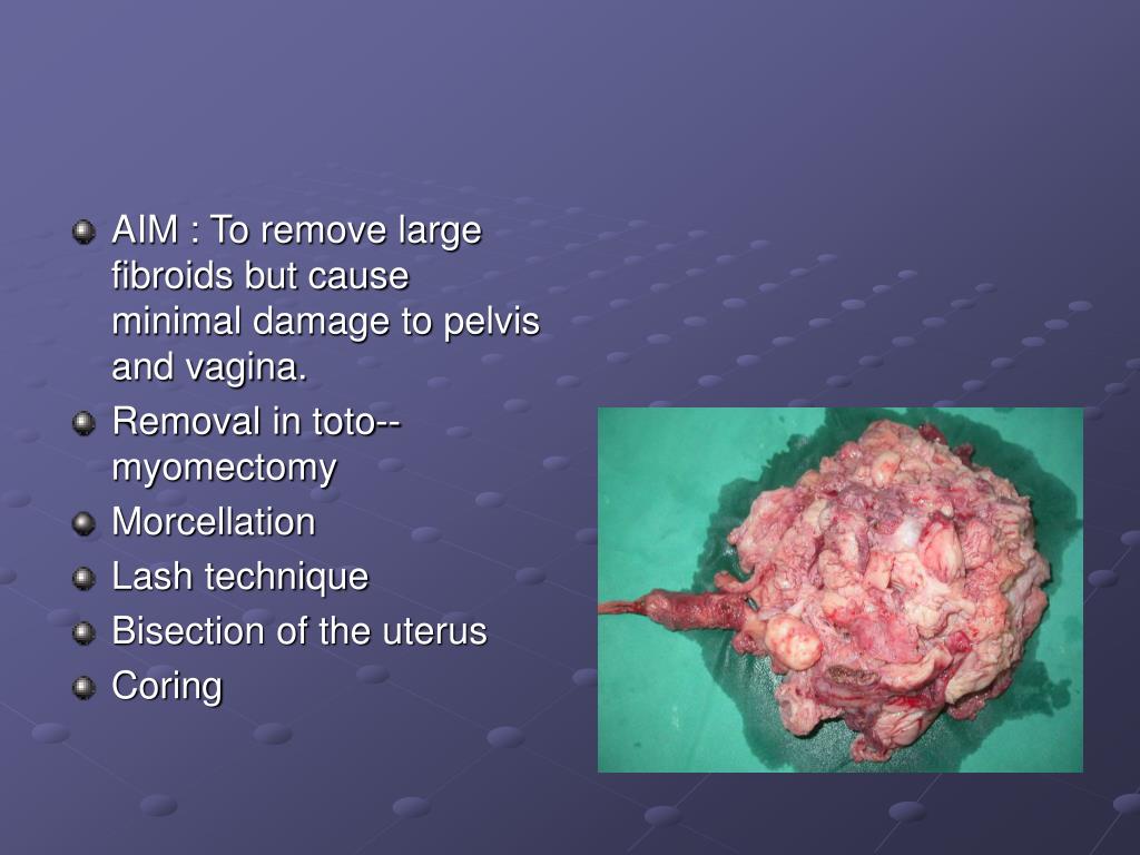 Ppt Vaginal Hysterectomy For Big Uteri Powerpoint Presentation Free