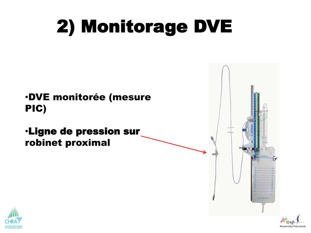 PPT - LA DERIVATION VENTRICULAIRE EXTERNE DVE PowerPoint Presentation ...