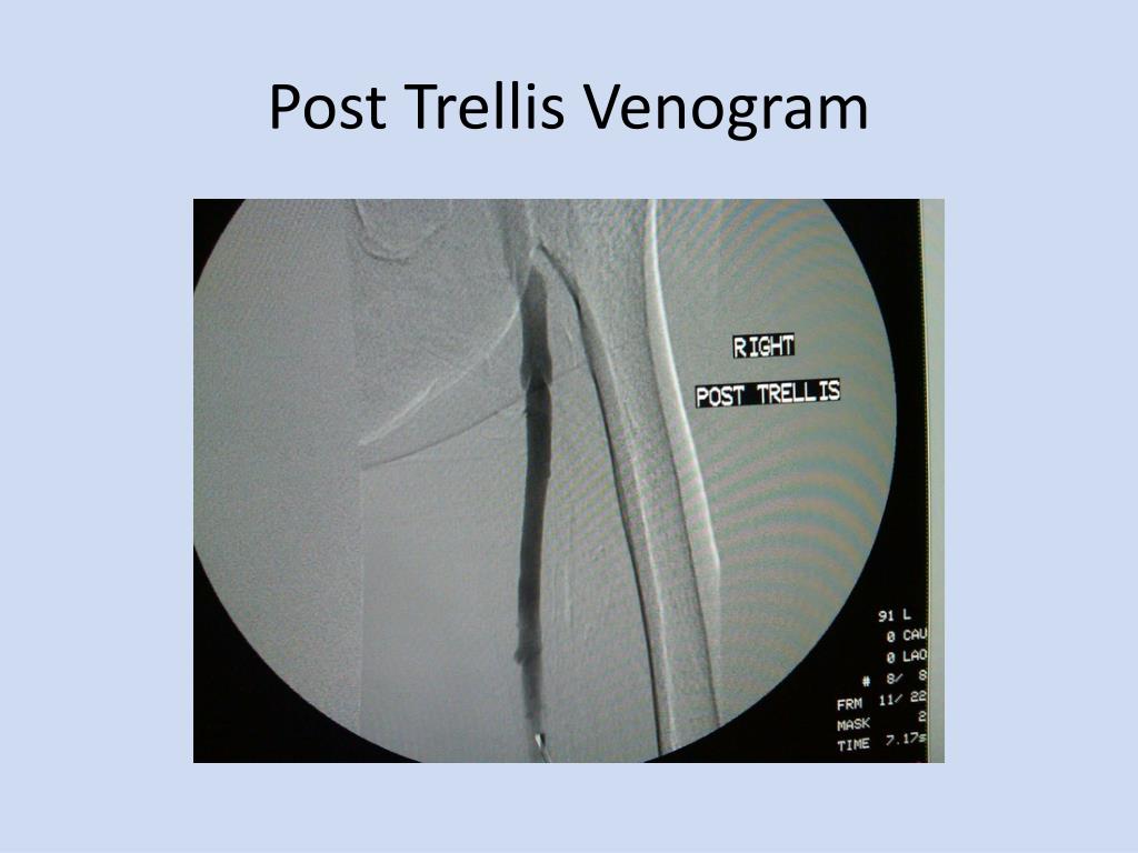 PPT - Endovascular Treatment for Patients with Deep Vein Thrombosis ...