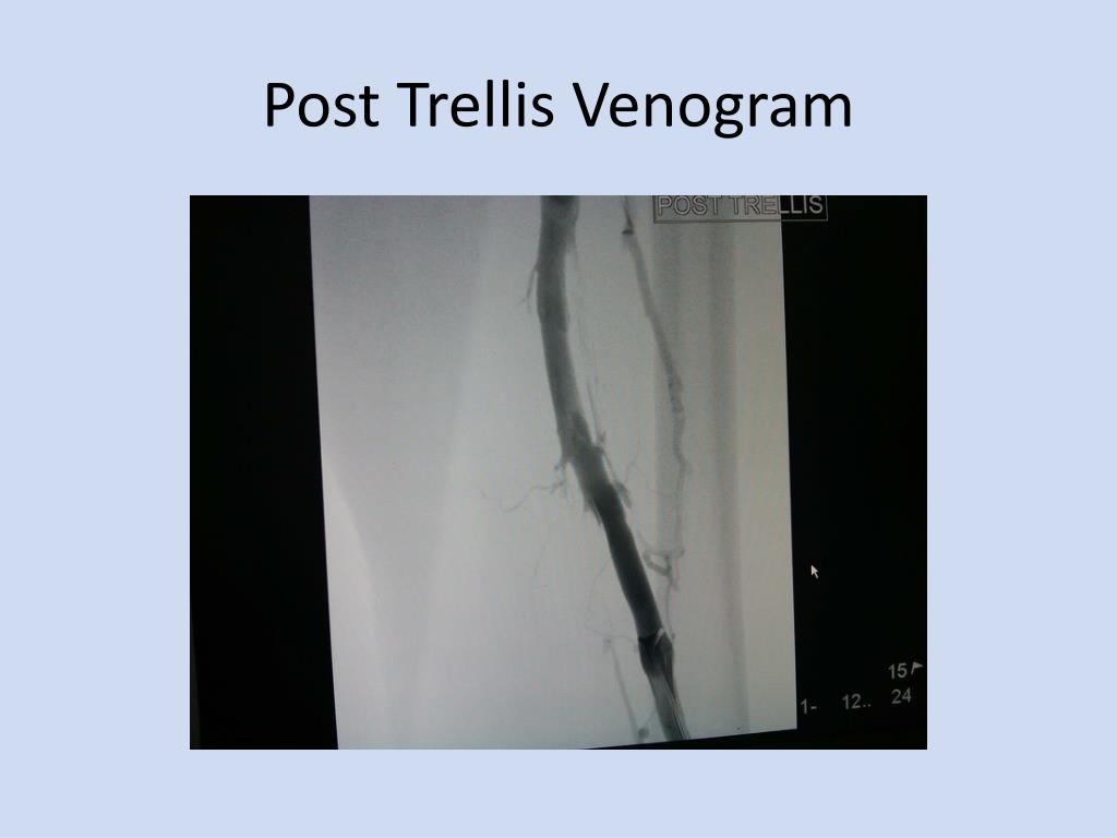 PPT - Endovascular Treatment for Patients with Deep Vein Thrombosis ...
